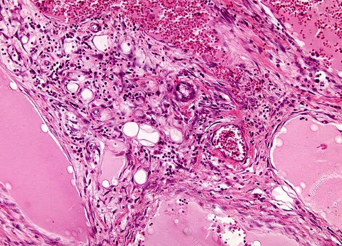 Cavernous Hemangioma At X Magnification Microscopyu Hot Sex Picture